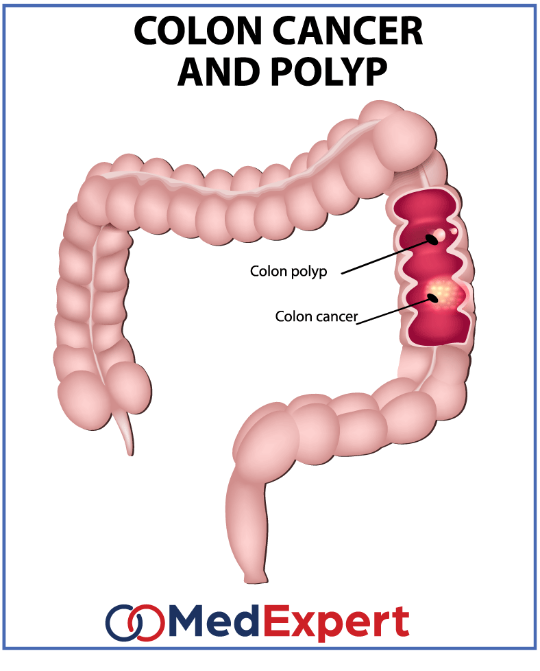Colon Cancer Diagnosis Treatment And Symptoms Med Expert